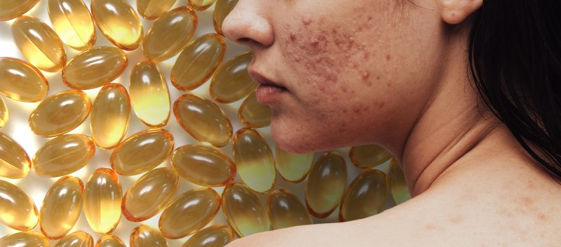 Omega 3-vetzuren verminderen bijwerkingen acnebehandeling | Advies over ...